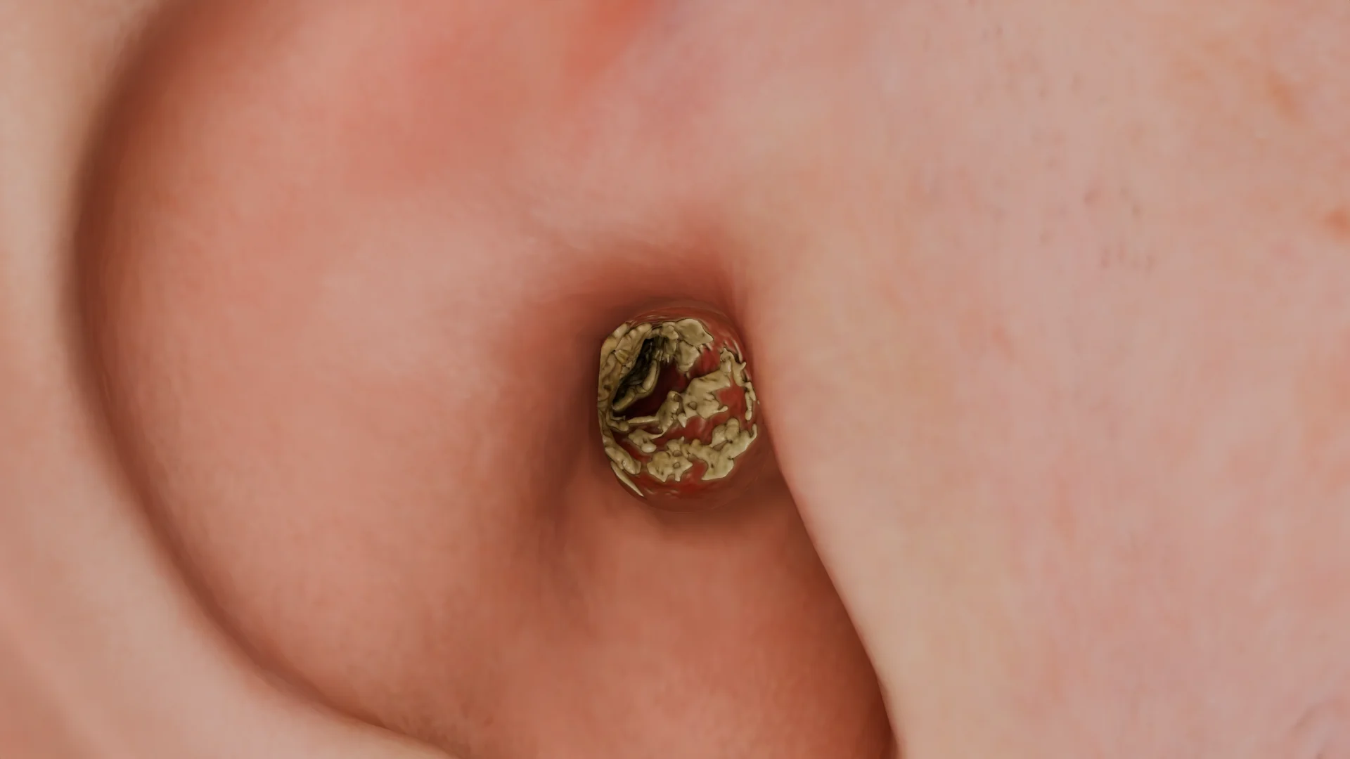 Otitis externa: Klassifikation, Ursachen, Symptome, Diagnostik und Behandlung